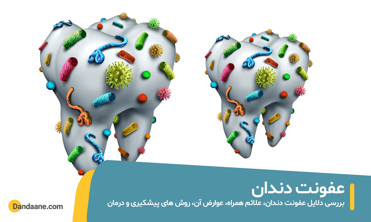 عفونت دندان؛ علت، علائم، روش های پیشگیری و درمان آن دندانه